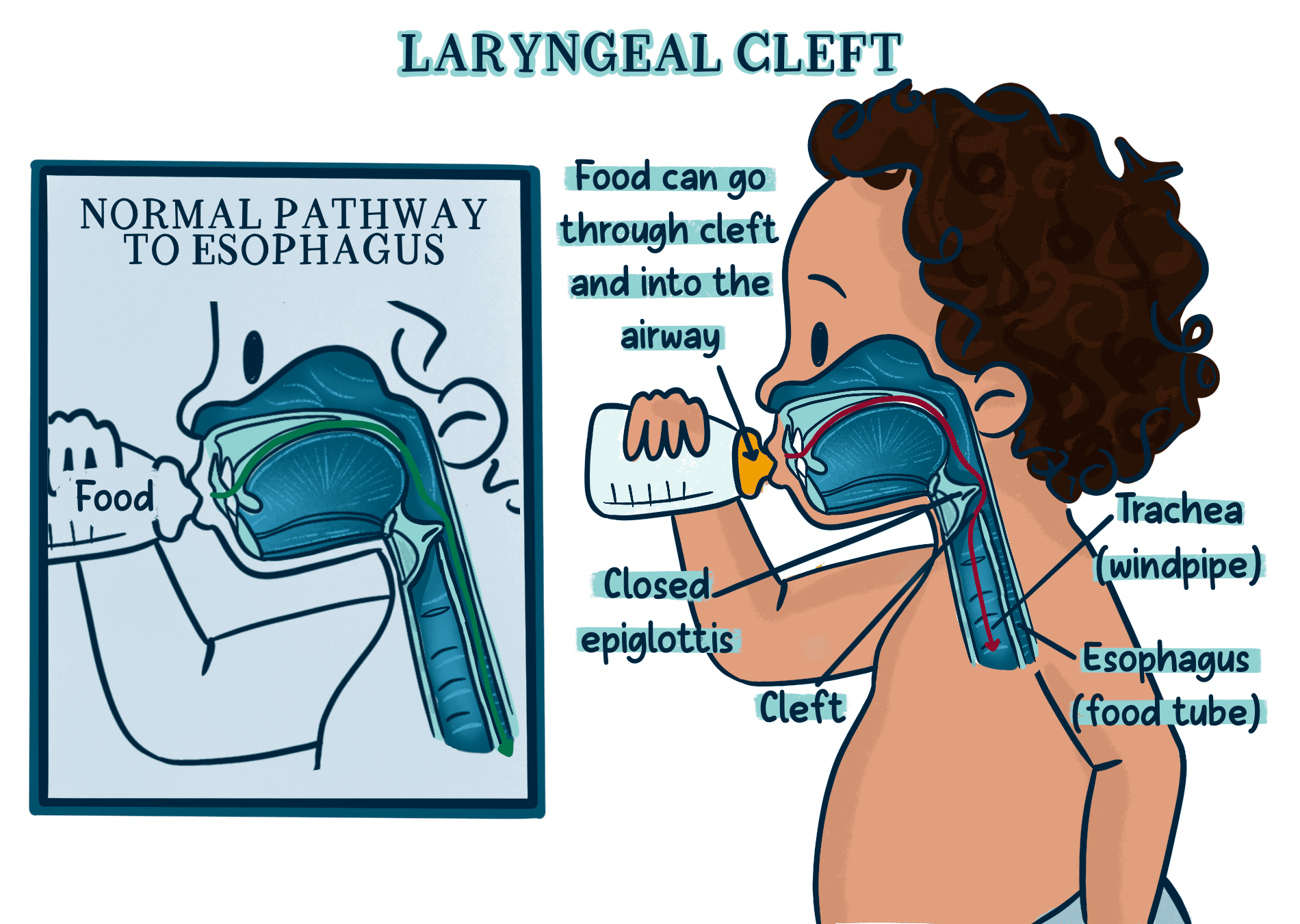 Mind the gap: Laryngeal cleft and pediatric swallowing